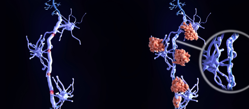 Experts Weigh in on Multiple Sclerosis | Pediatrix & Obstetrix