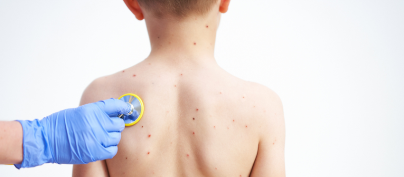 Monkeypox in Kids | Pediatrix & Obstetrix